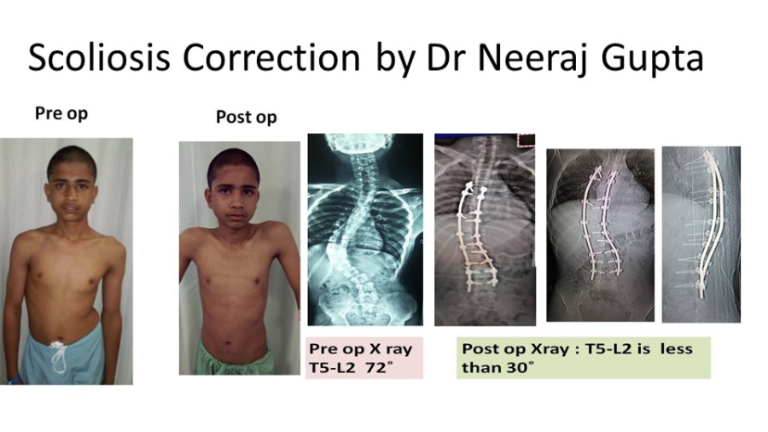 Dr Neeraj Gupta Spine surgeon – Empowering Healthy Spine for All